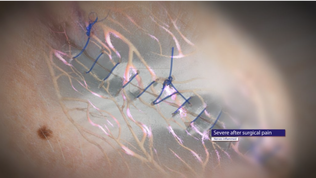 3D Medical Animation. Case study: Medical device Mechanism of action