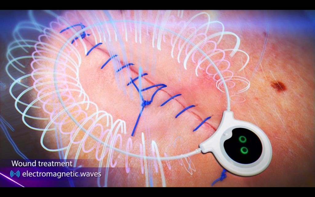 3D Medical Animation. Case study: Medical device Mechanism of action